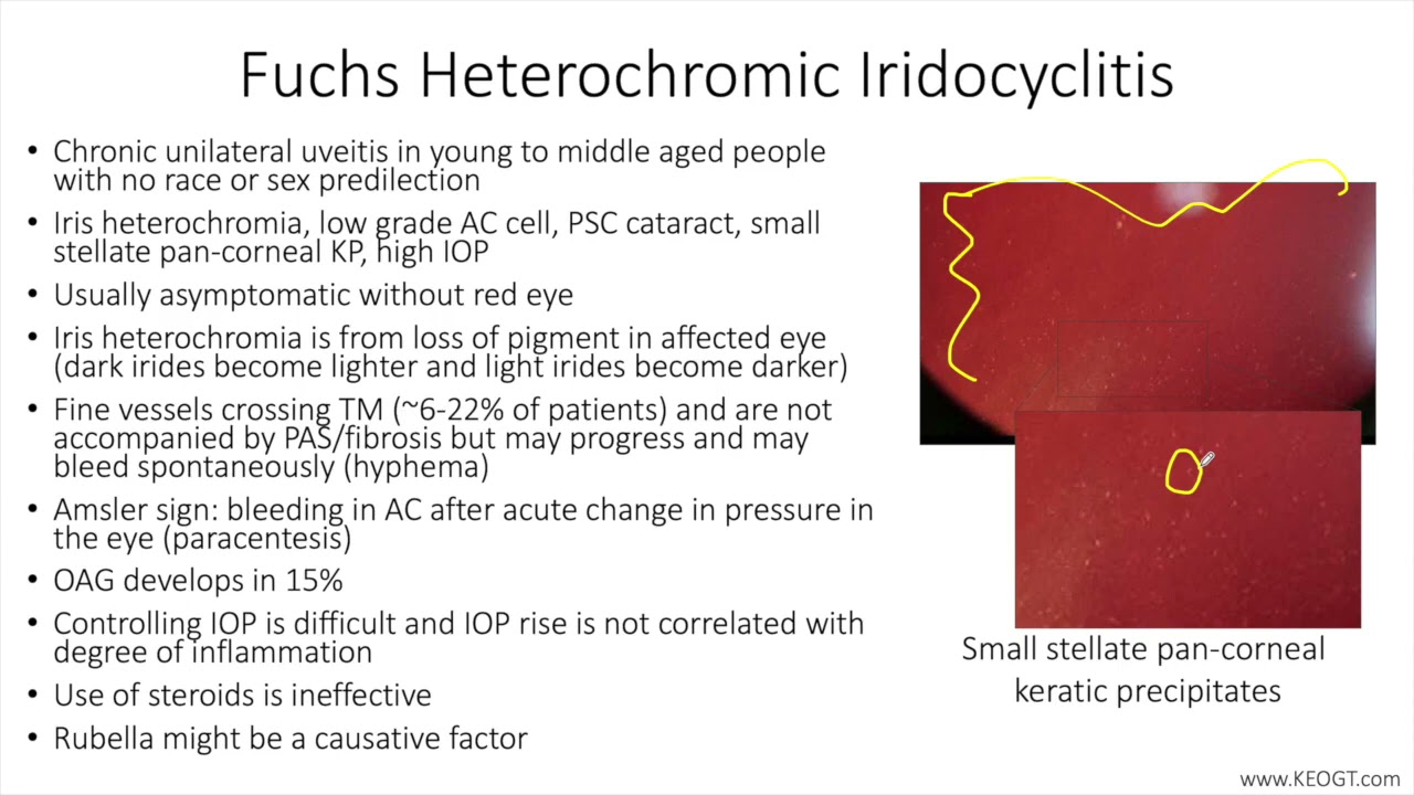 Lecture: Fuchs’ Heterochromic Iridocyclitis (1 Slide in 5 Minutes ...