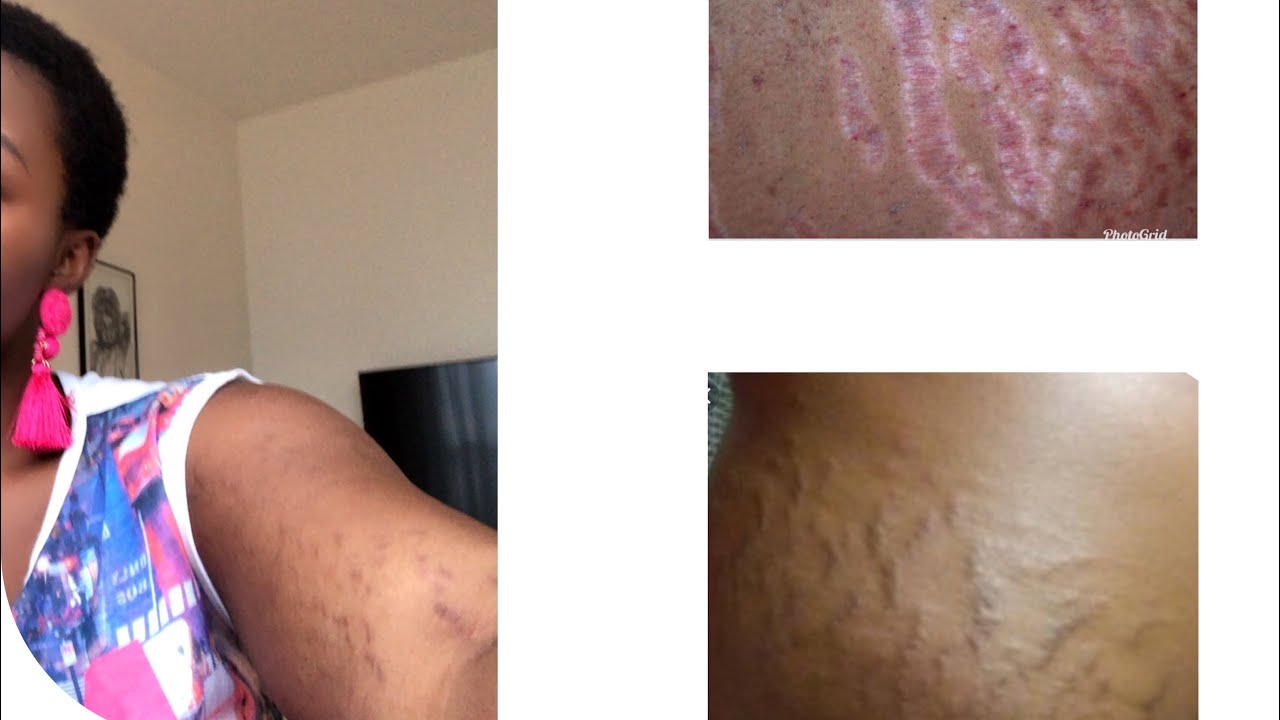 Tiba Ya Kuondoa Michirizi Au Stretch Marks Na Makunyanzi Kwa Haraka ...