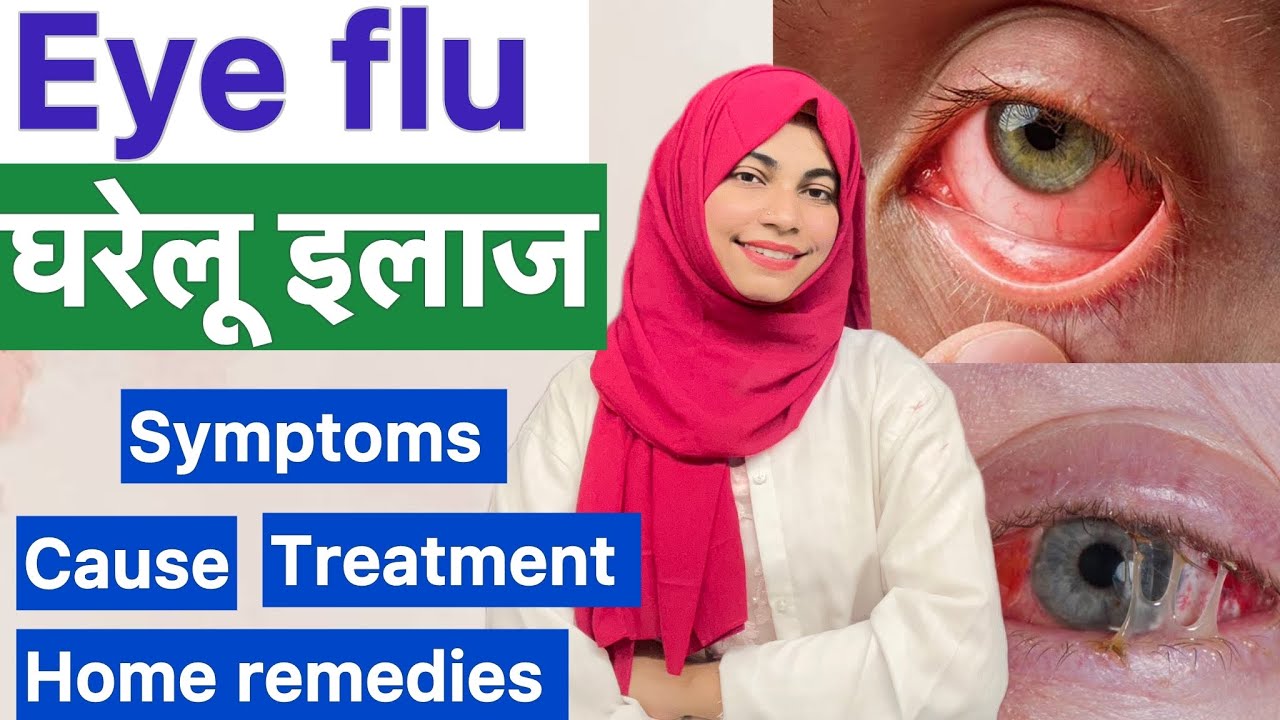 Eye flu घरेलू इलाज ,symptoms,cause,treatment | eye flu केस ठीक करे ...
