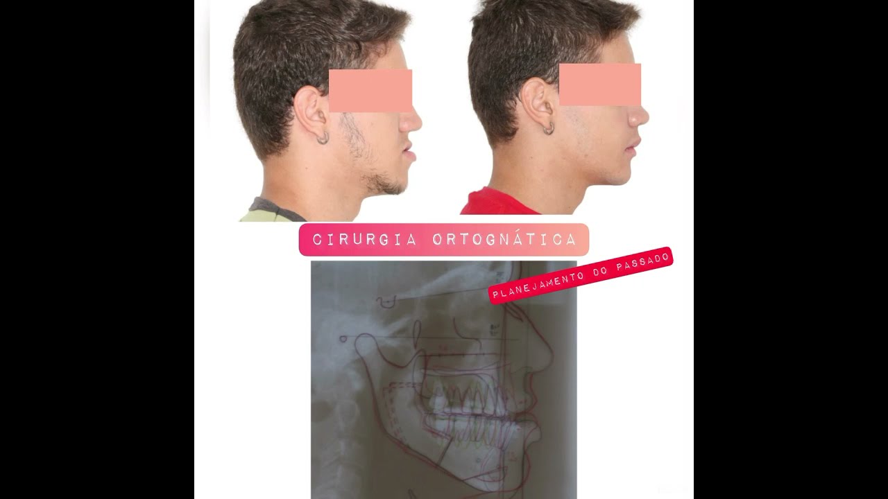 Clínica Le Fort - Cirurgia Ortognatica - YouTube