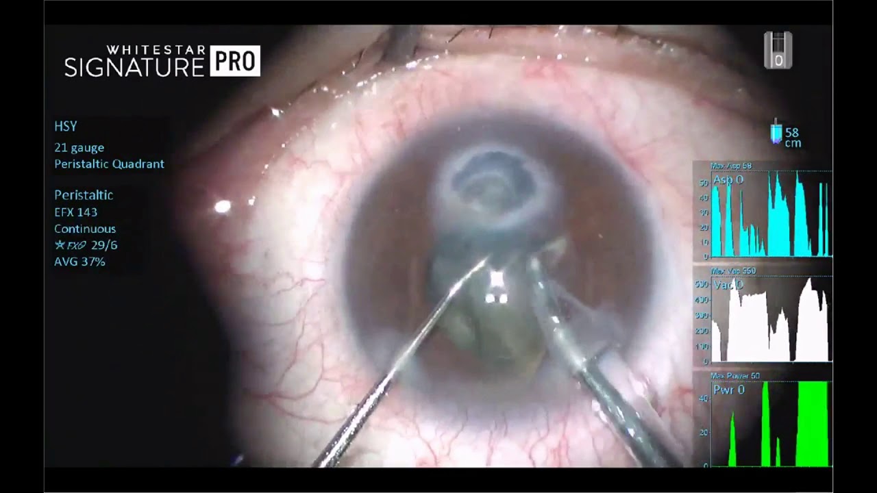 PPC device for challenging cataract surgery cases - Supplementary video ...