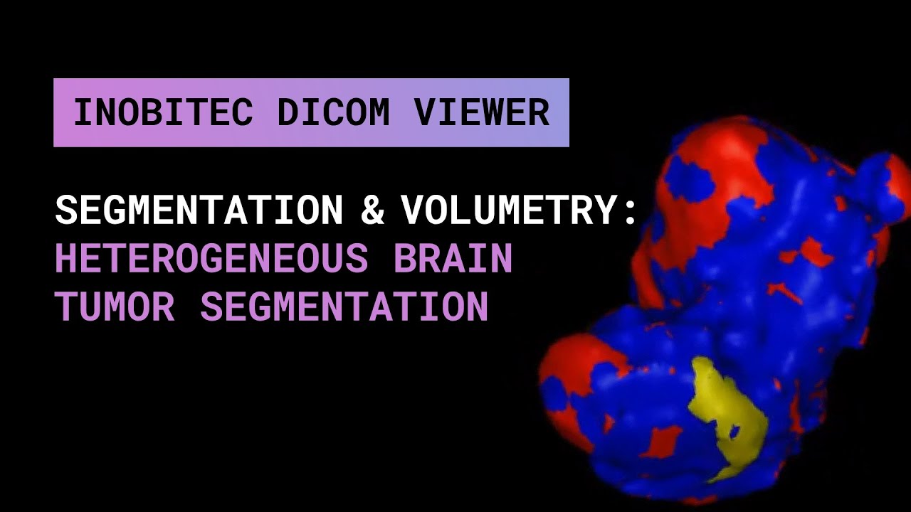Segmentation and volumetry: heterogeneous brain tumor segmentation ...
