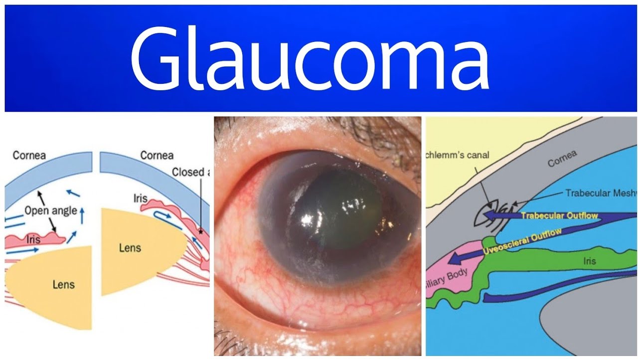 Glaucoma 3 | Primary Open Angle Glaucoma - YouTube