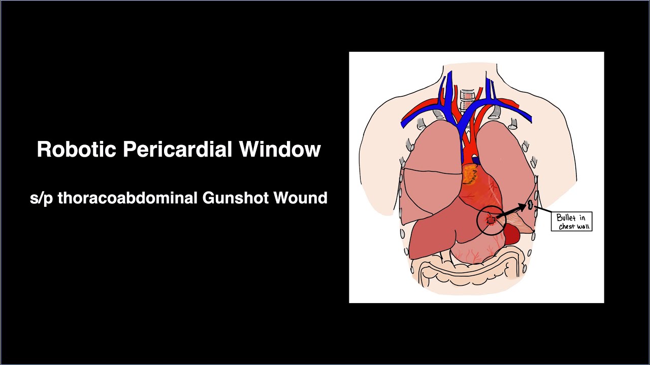 Robotic Pericardial Window (transabdominal approach s/p thoraco ...