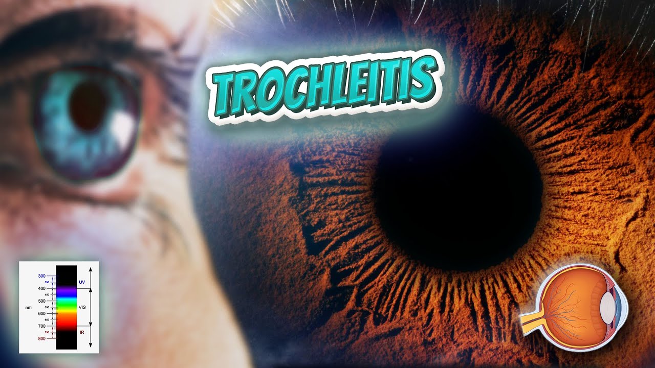 Trochleitis (Your EYEBALLS) 👁️👁️💉😳💊🔊💯 - YouTube