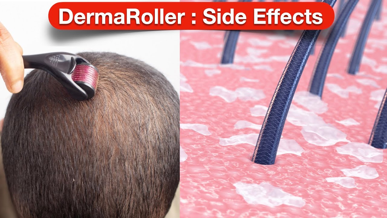 Derma roller ke Side Effects: क्या Derma roller से Dandruff बनते है ...