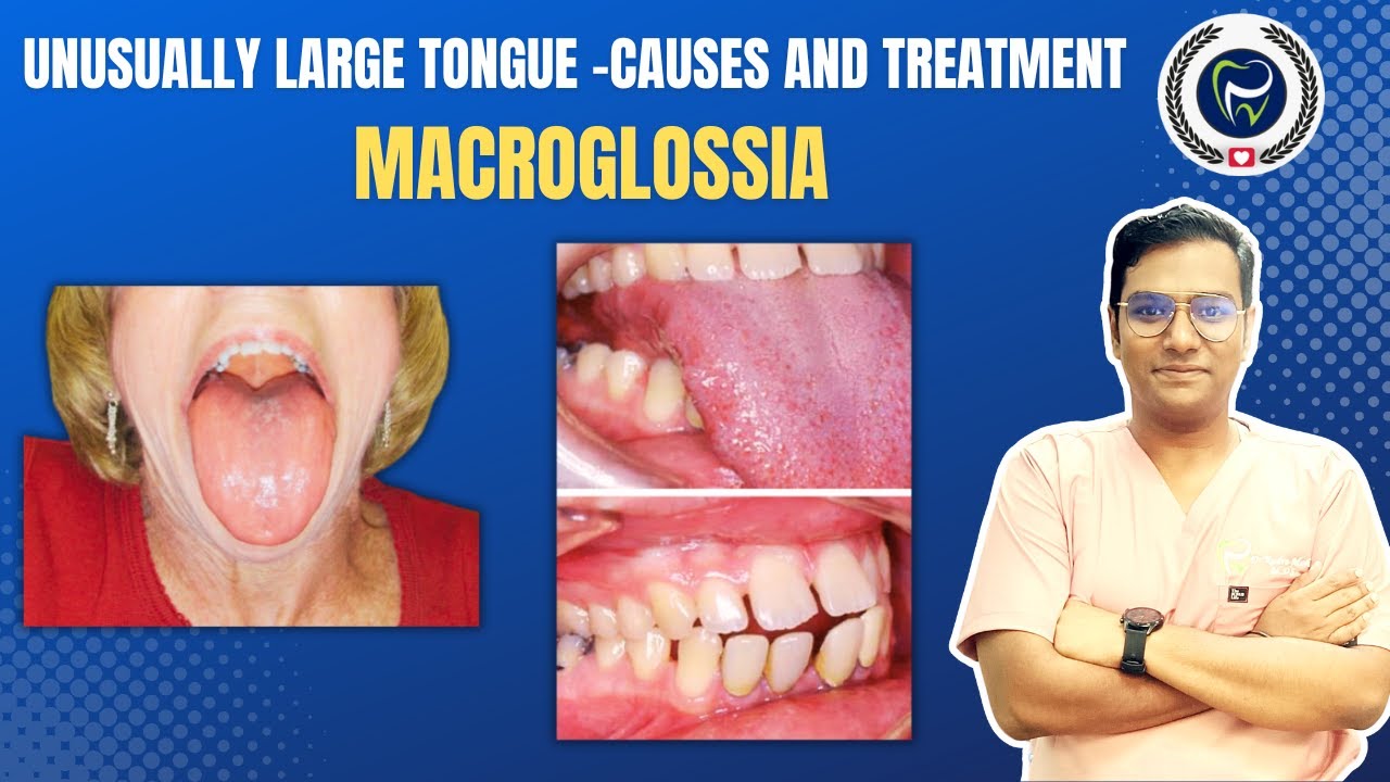 Dr Rudra Mohan | Macroglossia - Enlarged Tongue - Understand Causes and ...