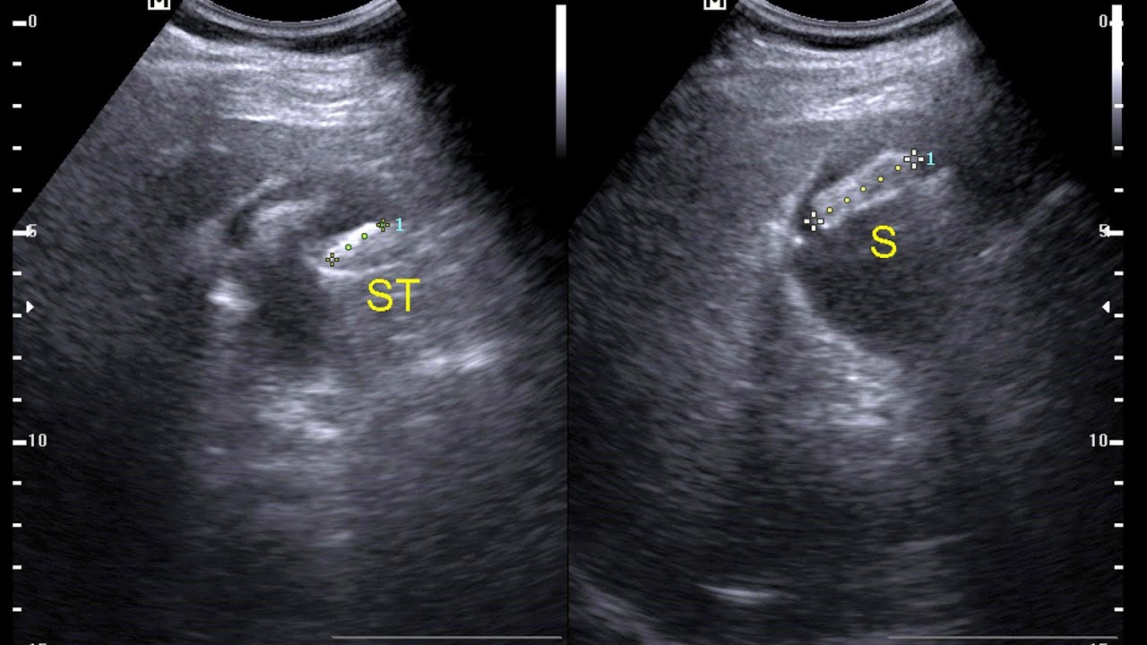 Ultrasound cases 393 of 2000 || Cholelithiasis || Tumefactive sludge ...