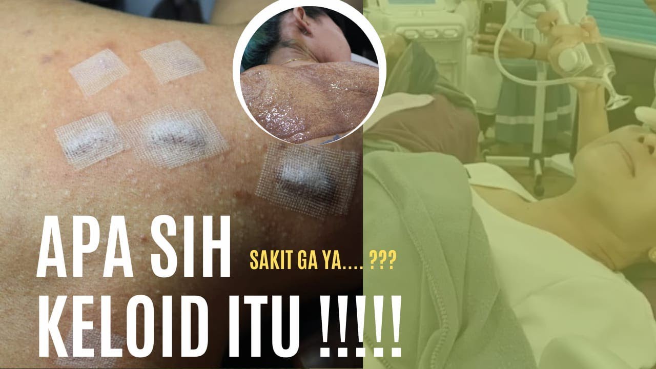 Jangan biarkan KELOID membesar - YouTube
