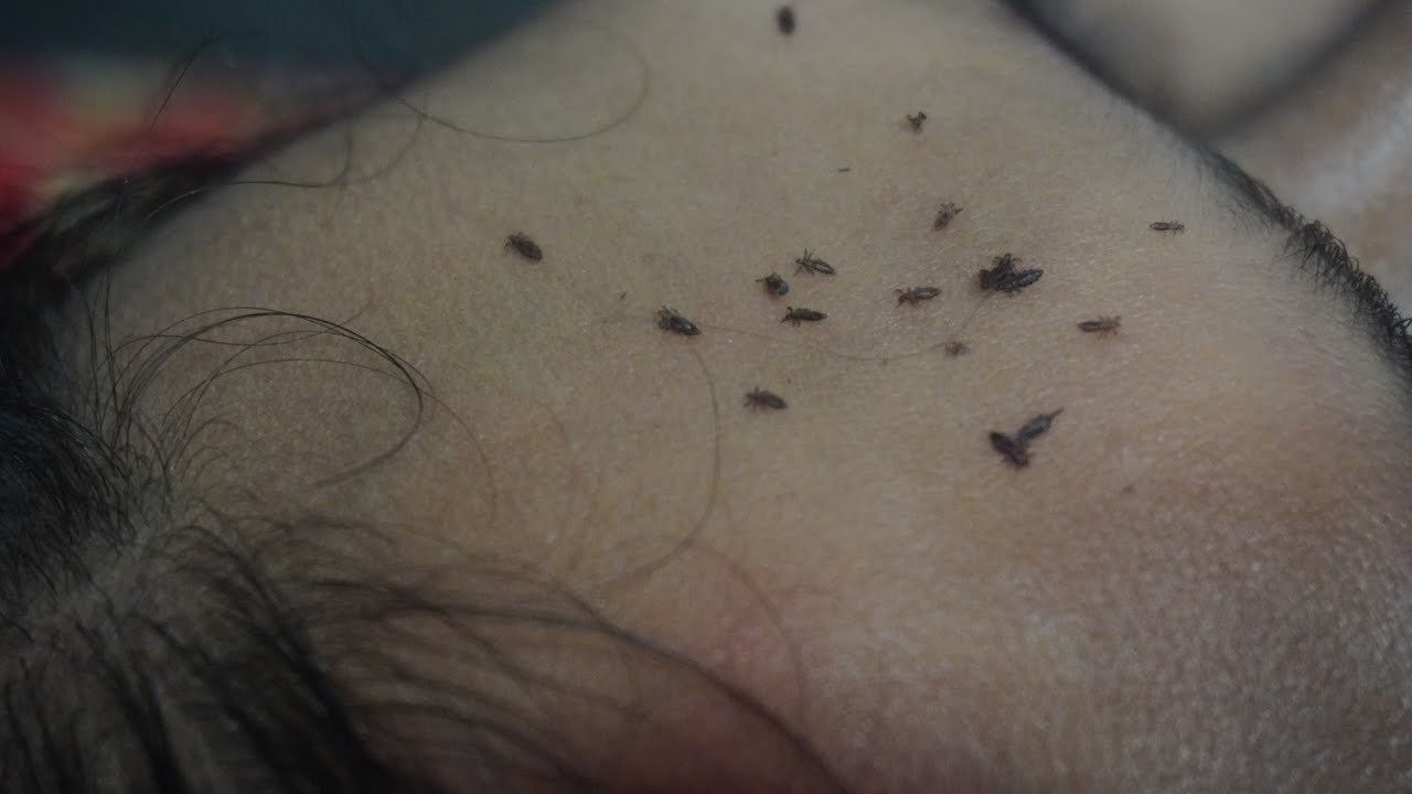 Oh Shit!! Lice Attack My Hair || Nitpicking Lice Infested || kutu ...