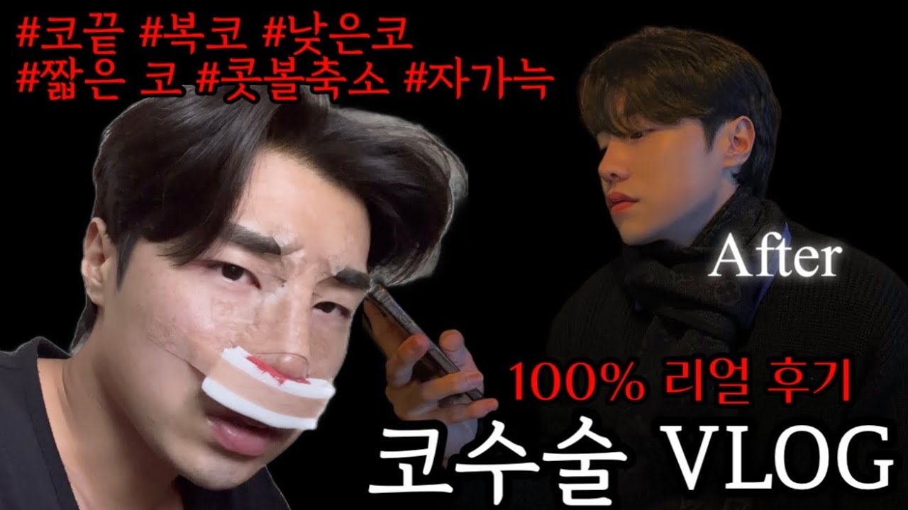 Vlog 코 성형 1~8일차 현실 브이로그 코 성형 코 수술 100 리얼후기 낮은 코 복코 짧은 코 코끝