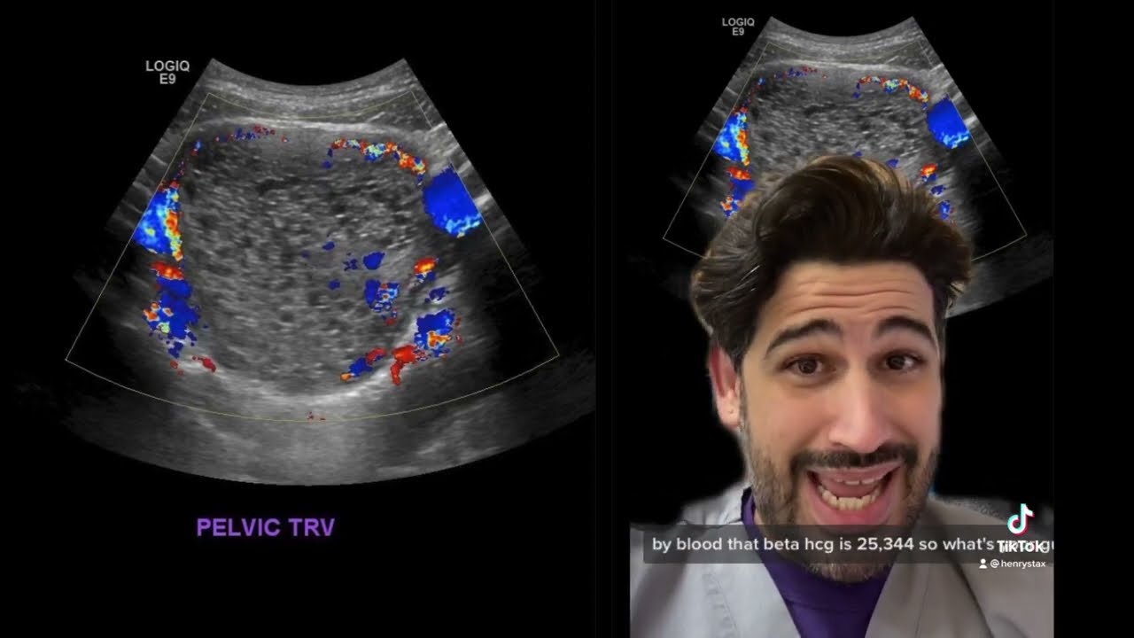 Molar Pregnancy - Hydatidiform Mole - YouTube