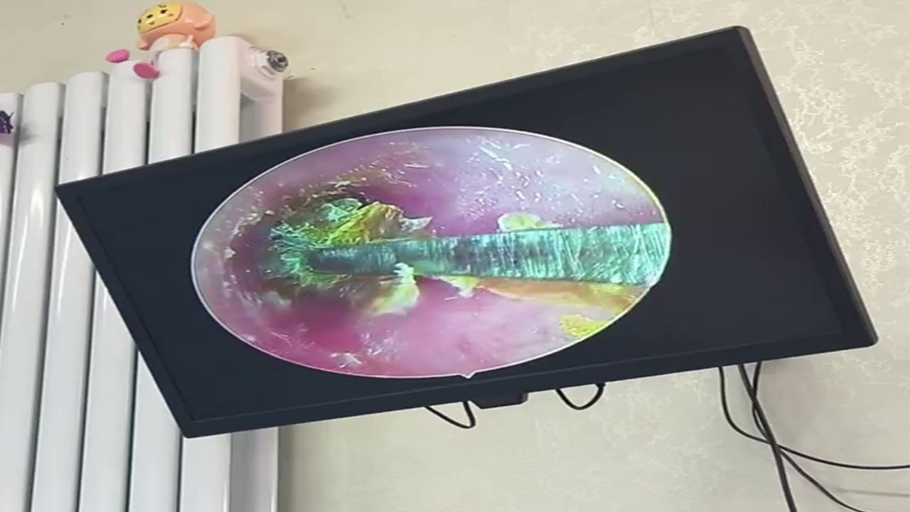 Ear Wax Removal - Satisfying Ear Wax Cleaning - Ear Wax Removing At ...