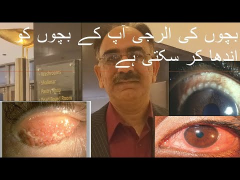 spring catarrh|VKC|vernal keratoconjunctivitis|eye allergy|allergies ...