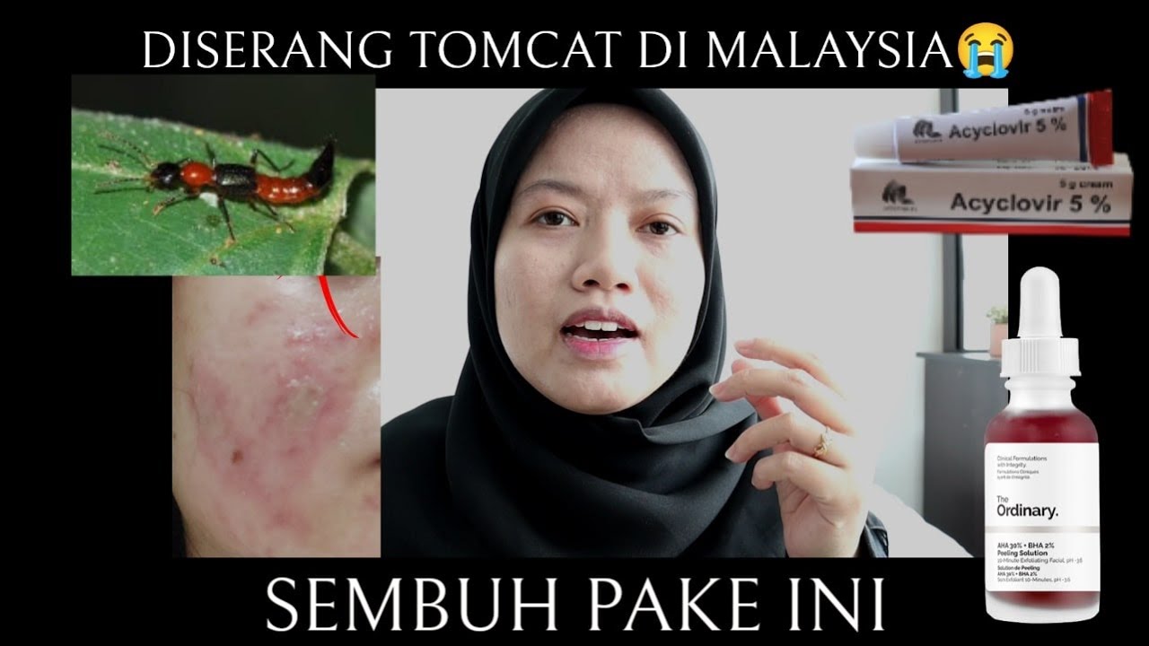 CARA MENGHILANGKAN LUKA TOMCAT / SEMUT CHARLIE PAKAI ACYCLOVIR + THE ...