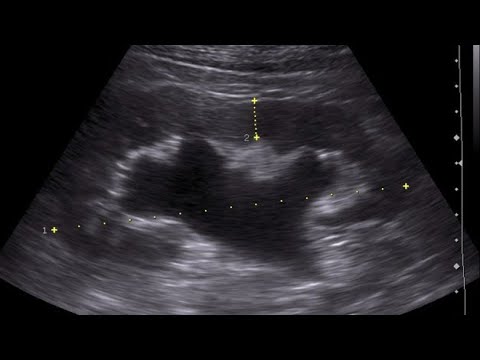 # Hydronephrosis|| ## Ureteric calculus|| ## Right Uretic calculus ...