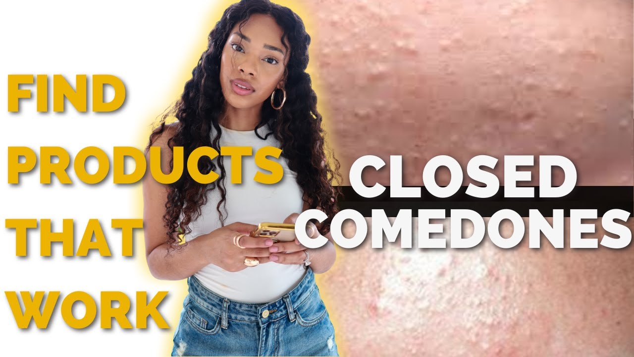 How to find skincare products for Closed Comedones | Finally Get Rid of ...