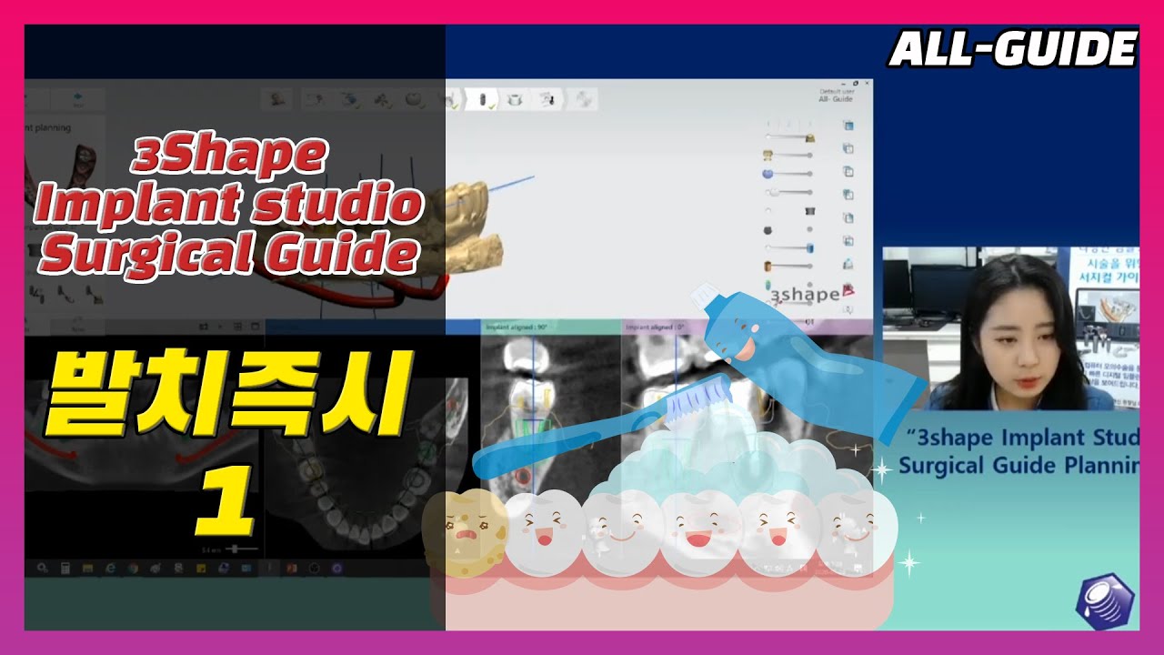 3Shape Implant studio Surgical Guide 4 - 발치즉시 1 - YouTube