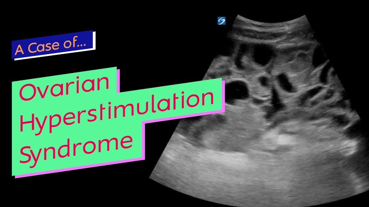 Ovarian Hyperstimulation Syndrome Ultrasound Ovarian Hyperstimulation