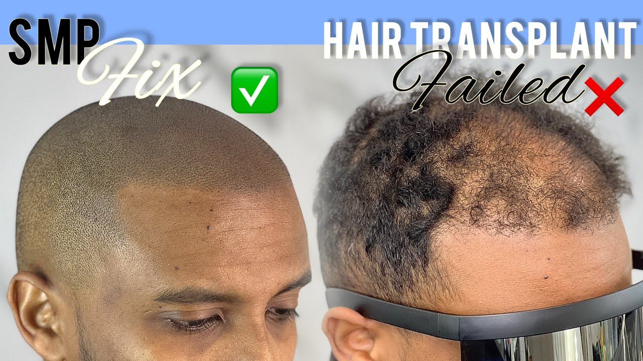 Hair transplant failure story: SAVED by SCALP MICROPIGMENTATION SMP ...