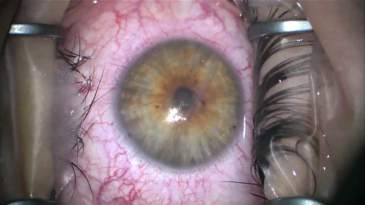 Corneal Laceration repair - YouTube
