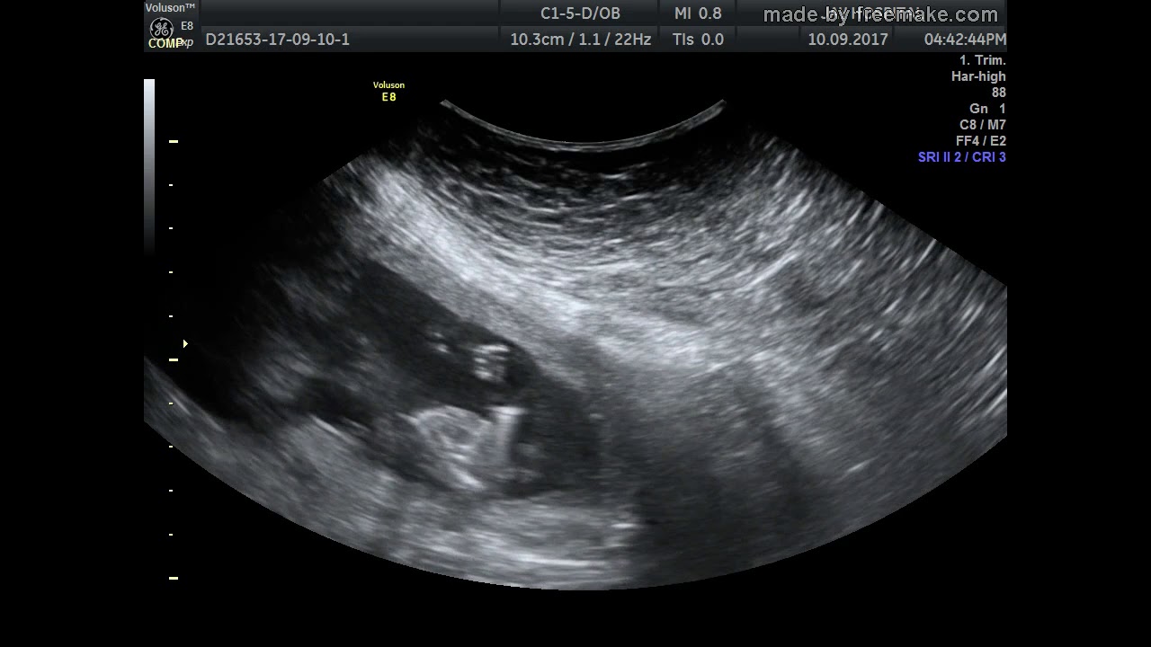 Fetal reduction by Dr Jay Lakhani - YouTube