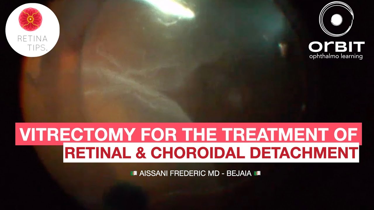 Orbit Tips 016 - Vitrectomy for the treatment of Retinal & Choroidal ...