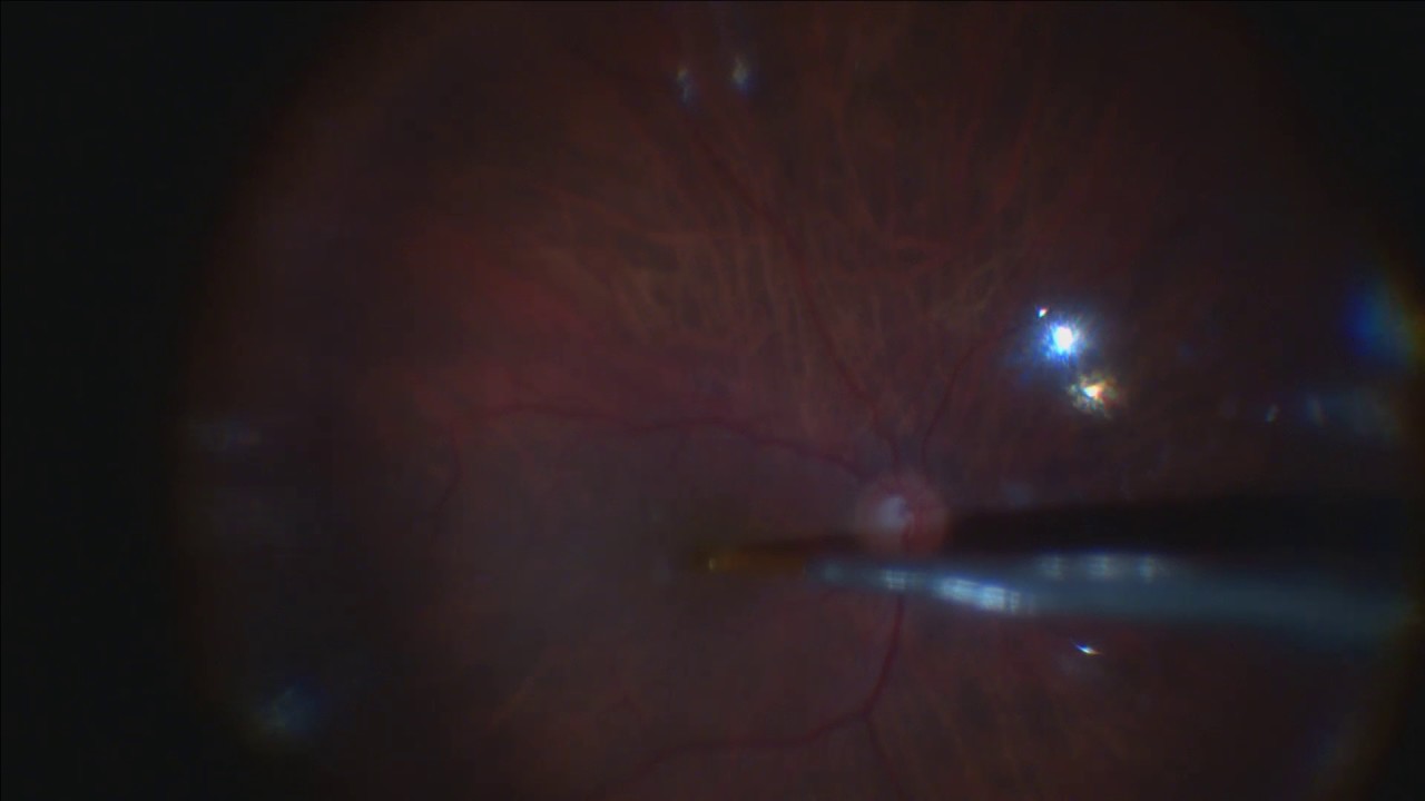 Unclosed macular hole after ILM peeling - tamponade with Oxane HD Lukan ...