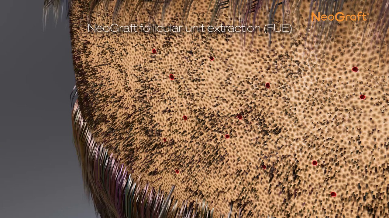 NeoGraft Hair Transplant System Explained Follicular Unit Extraction ...