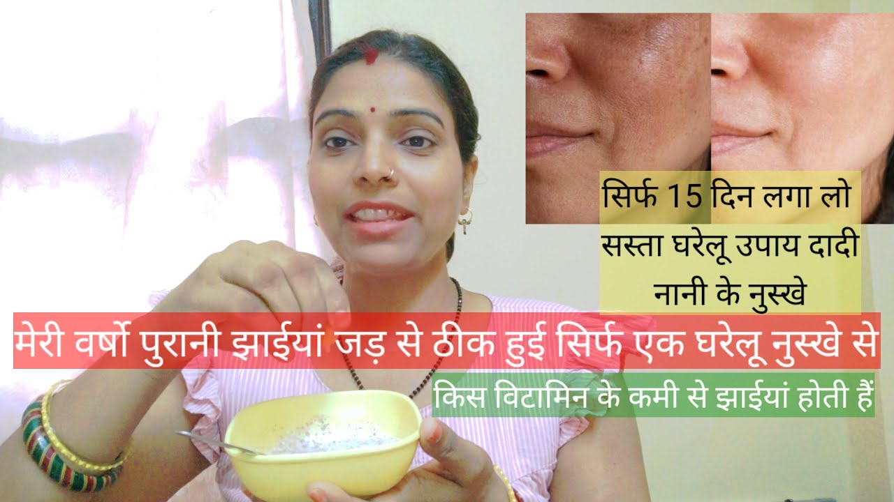jhaiya (Pigmentation) झाईयां हटाये सिर्फ 15 दिन में how to remove face ...