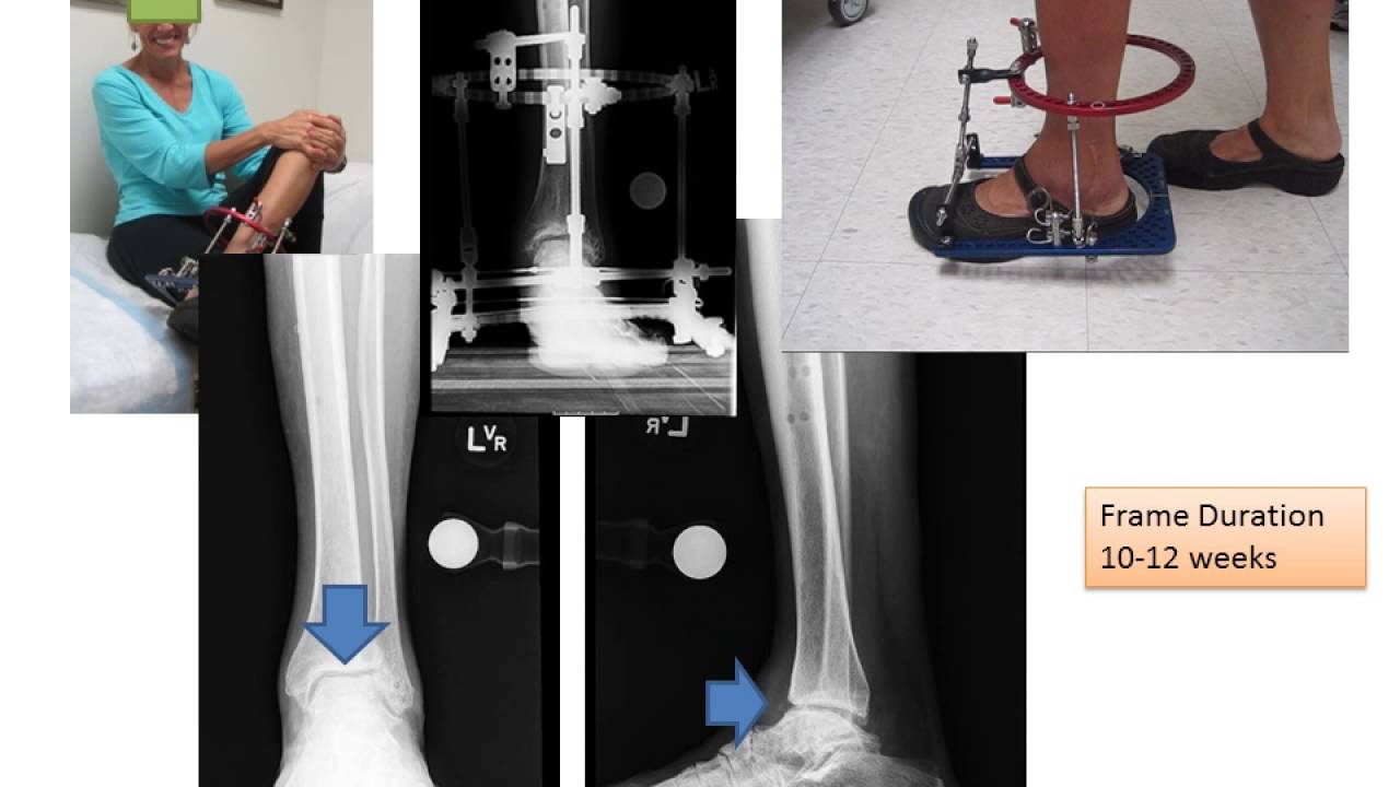 Ankle Distraction Surgery - YouTube