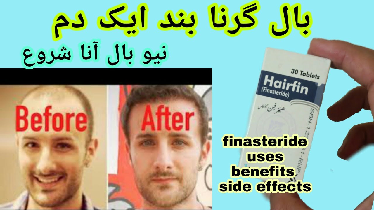 Finasteride review | Finasteride Benefits and Side Effects ...