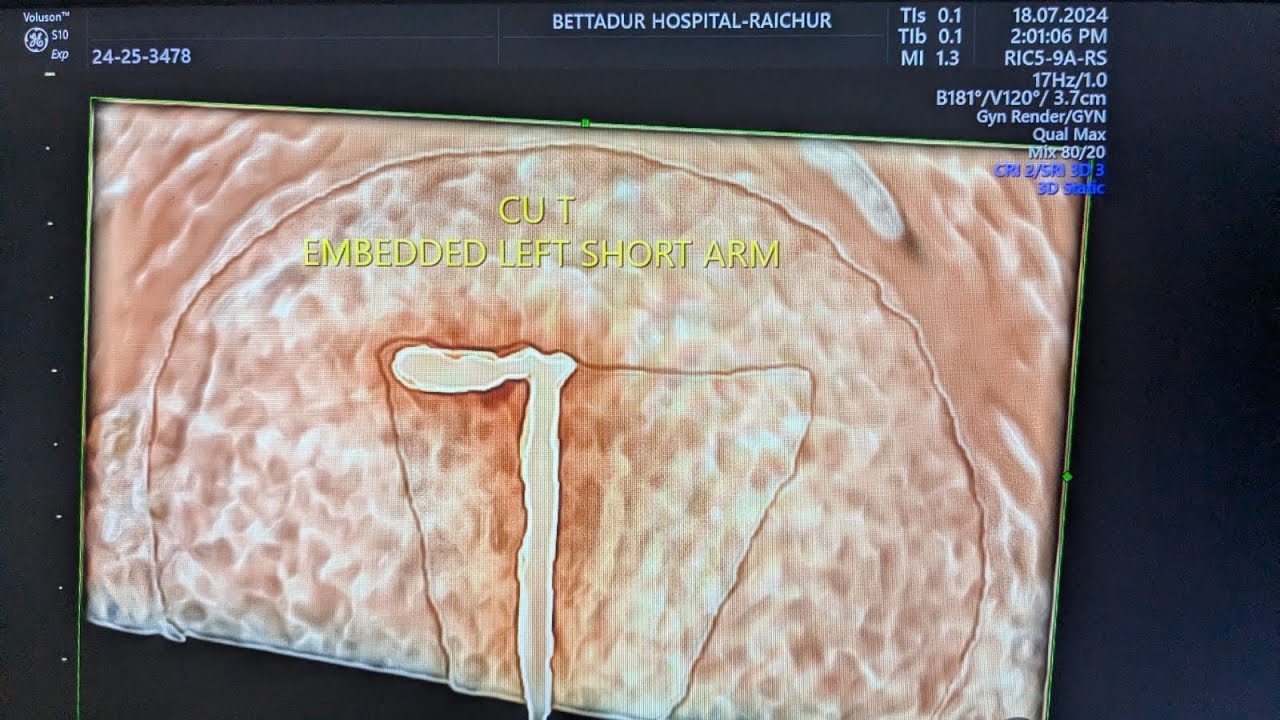Embedded Copper-T--- Daignosis and Hysteroscopic Removal - YouTube