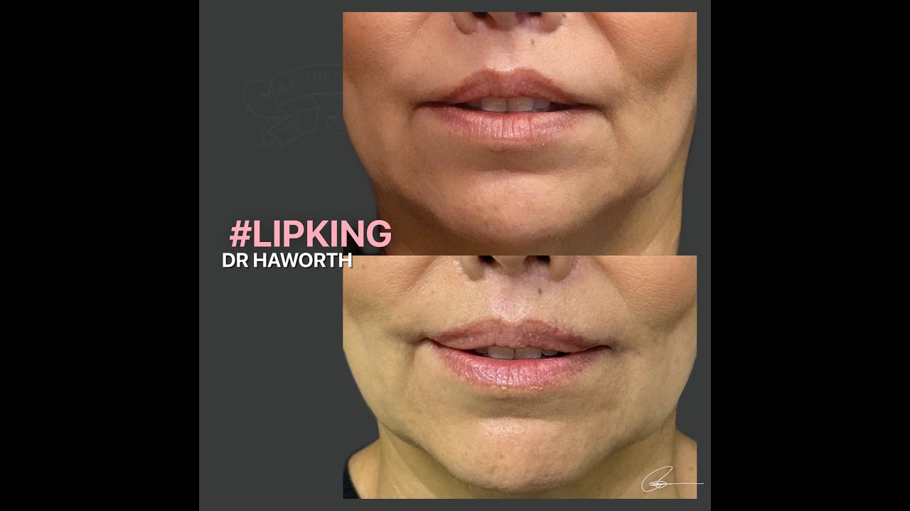Medialized corner lip lift - Amazing results after only 5 weeks ! - YouTube