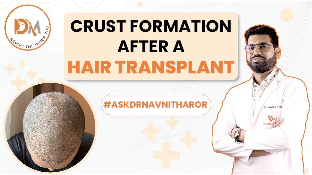 Crust Formation After a Hair Transplant - YouTube
