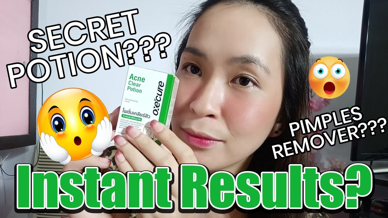 OXECURE ACNE CLEAR POTION REVIEW| PIMPLES REMOVER| INSTANT RESULTS ...