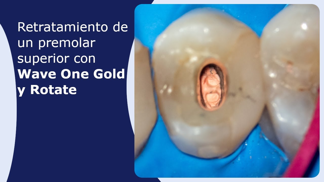 Retratamiento de un premolar superior con Wave One Gold y Rotate - YouTube