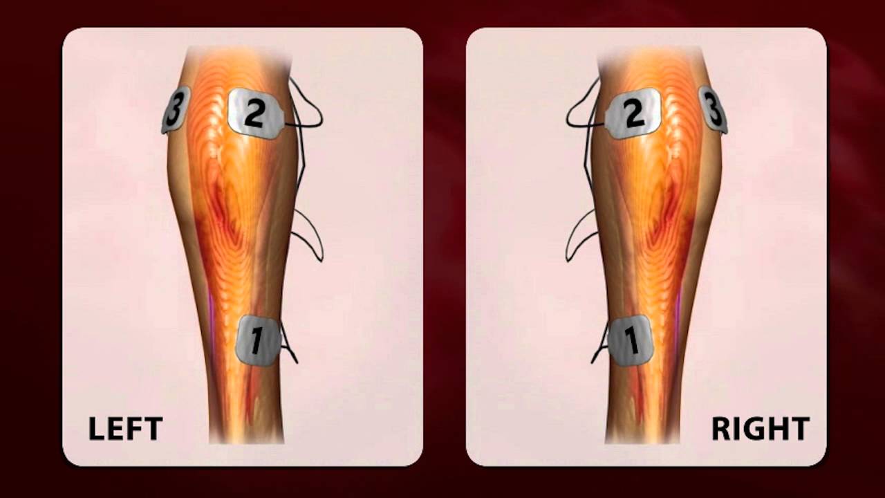 FlowAid FA100 - Instructions for Use - YouTube