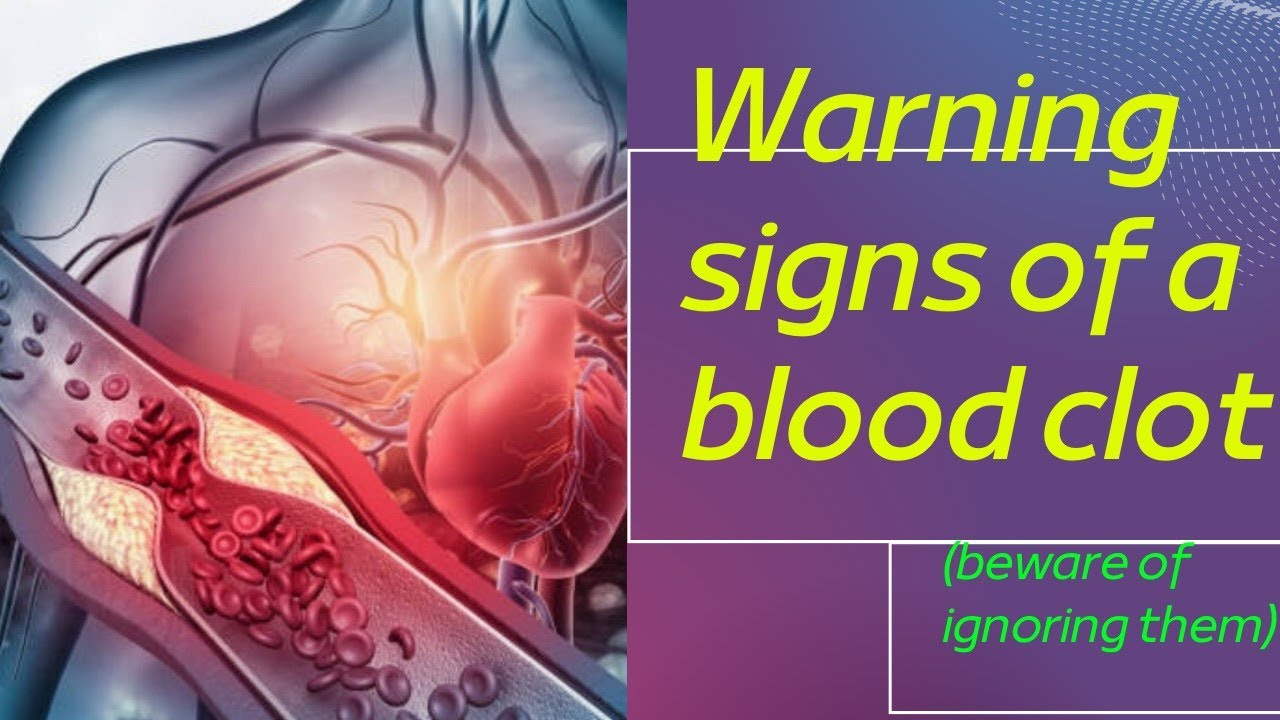 Warning signs of a blood clot (beware of ignoring them) - YouTube