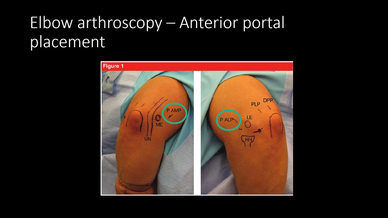 Arthroscopic release of elbow contractures 2019 - YouTube