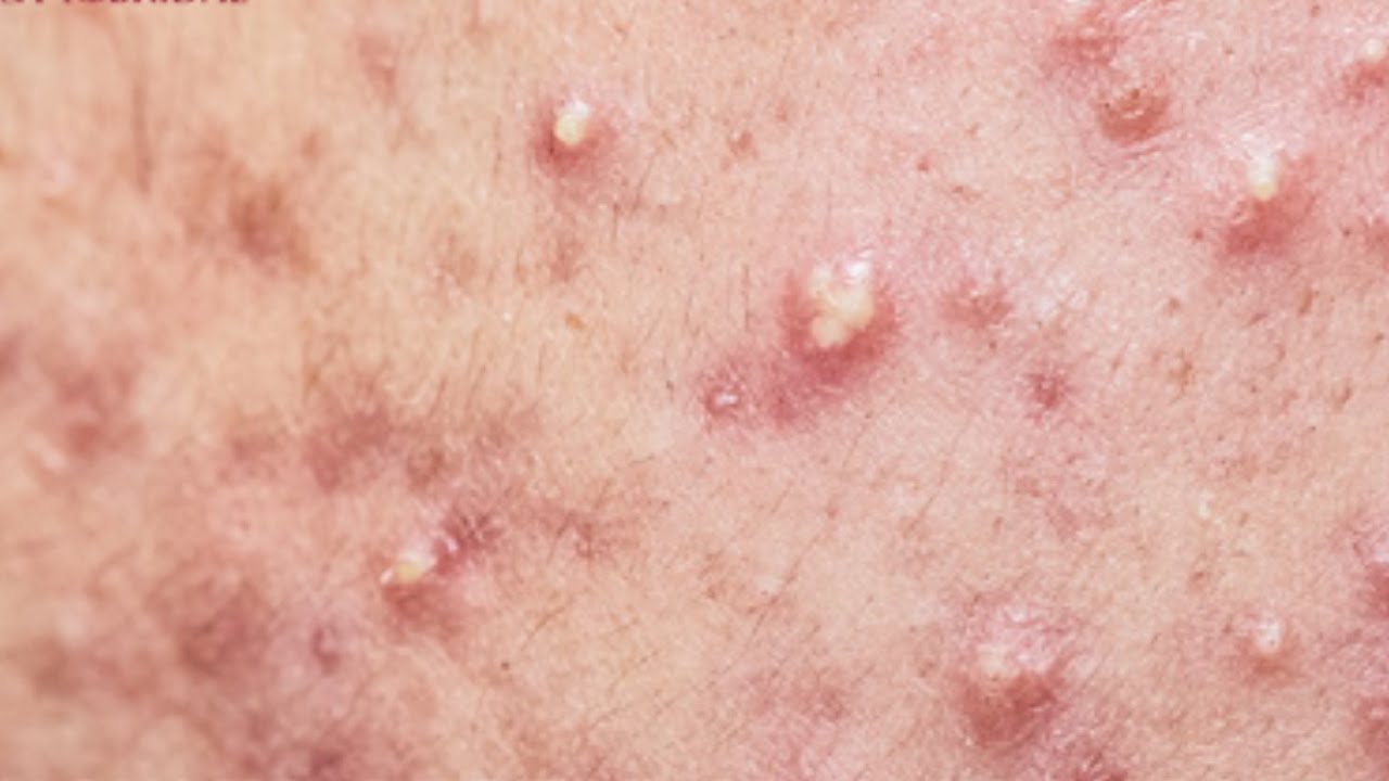 NEW Pimple Popping Compilation OF #2021 // Satisfying and relaxing ...