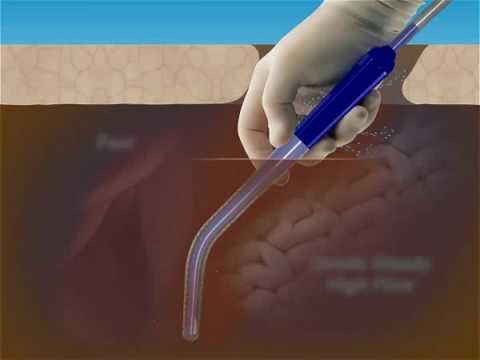Atraumatic Dual-Action Suction - YouTube