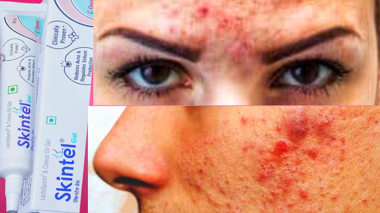 क्या आपको भी Acne or Pimples हो गए हैं ? use करिए ये skintel Gel और ...