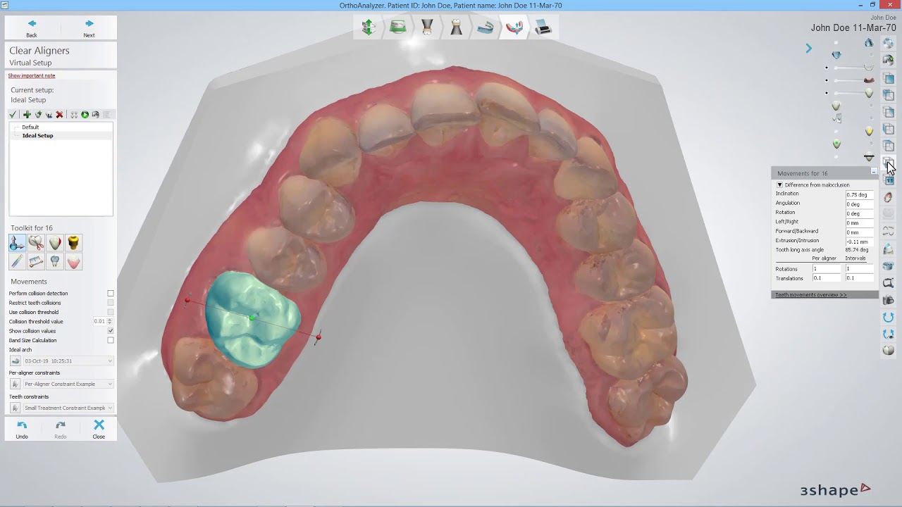 3Shape Clear Aligner Studio - Teeth movement in Virtual Setup BR-PT - YouTube