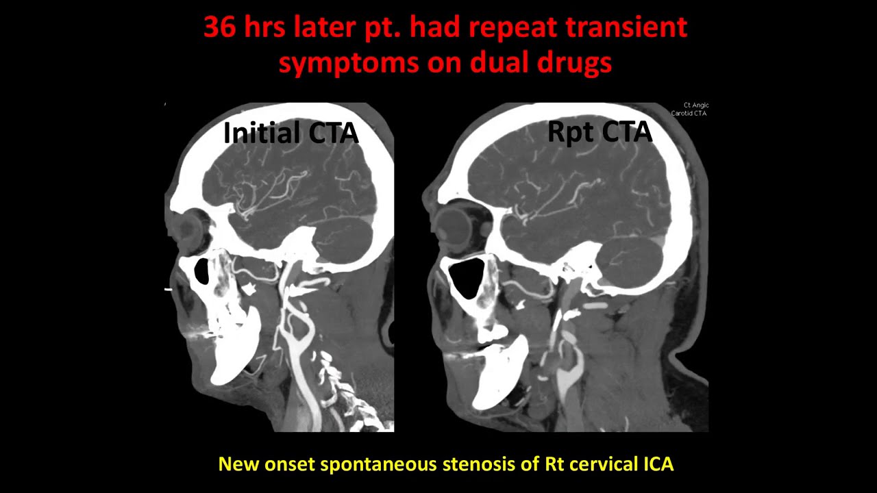 Bilateral Cervical ICA Dissections: stenting - YouTube