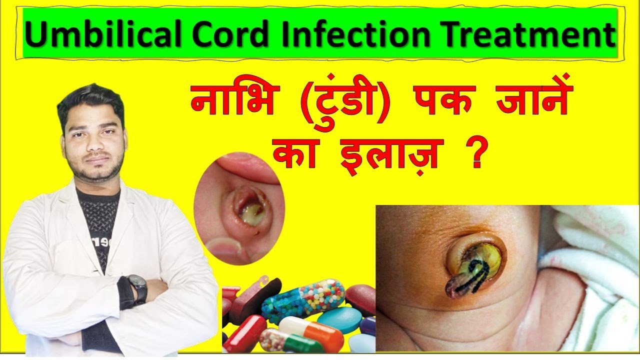 नाभि के पक जानें का इलाज। Umbilical Cord Infection Couses & Treatment ...