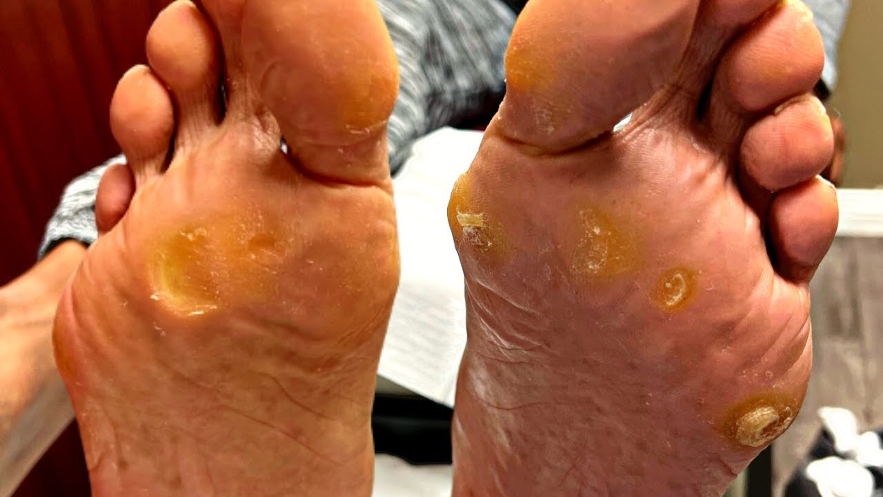 MULTIPLE Deep Seeded Corn Removals! | Dr Kim, Kim Foot and Ankle - YouTube