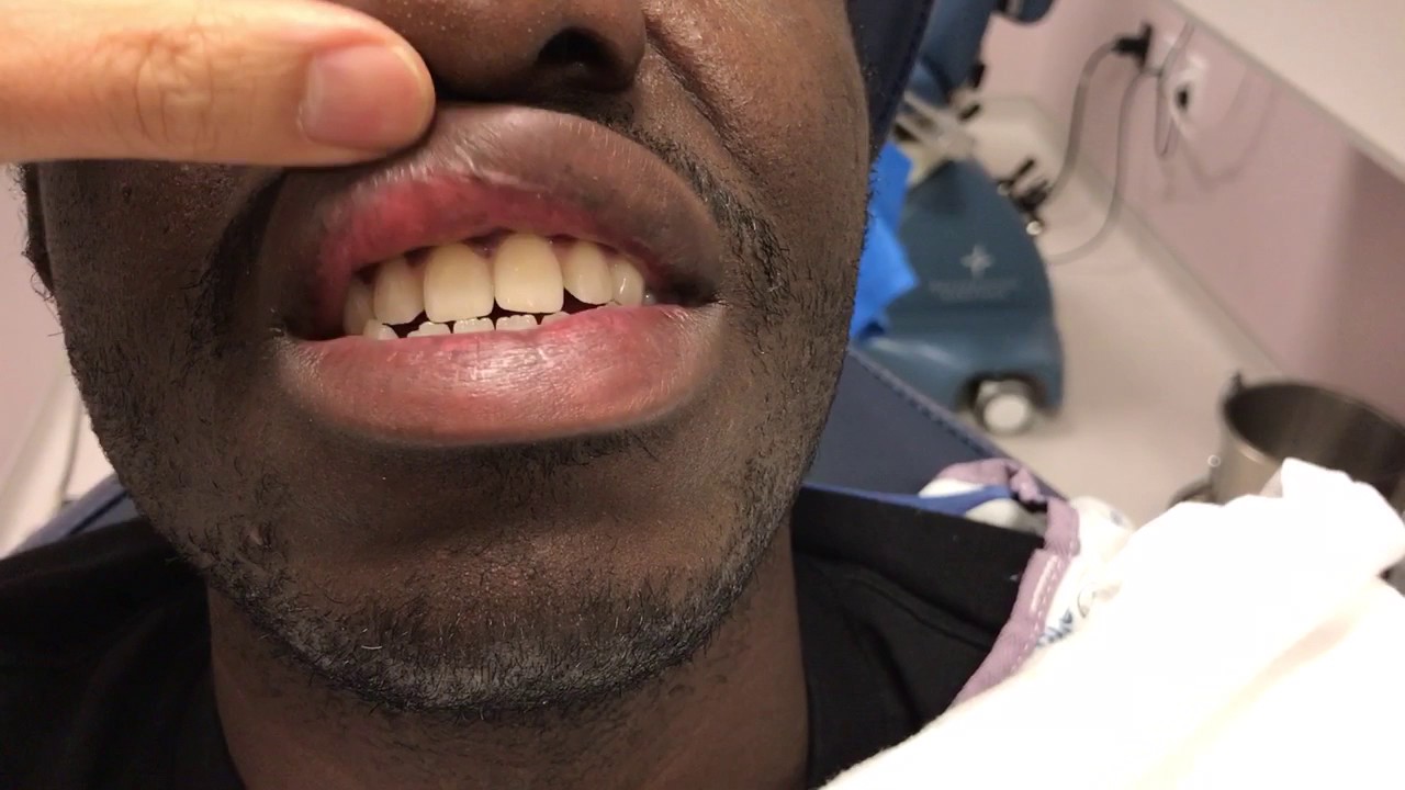 African-American Upper Lip Reduction Incision Closeup in Dallas, Texas ...