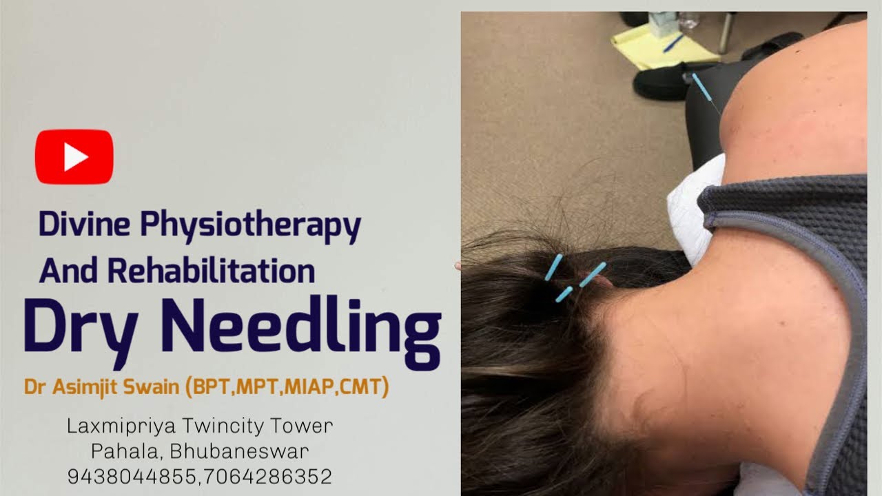 Dry needling for calf Muscle || Divine physiotherapy and rehabilitation ...