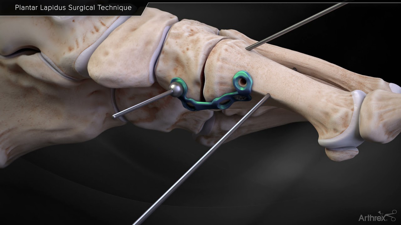 Plantar Lapidus Surgical Technique - YouTube